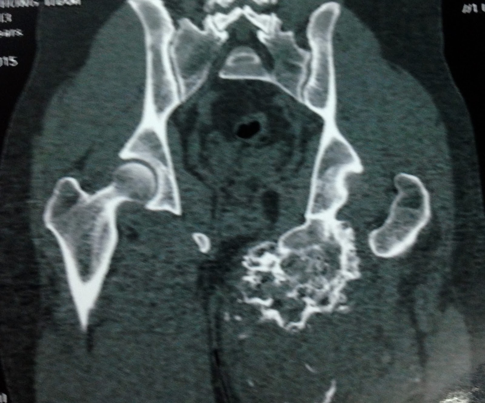 VIETNAMESE MEDIC ULTRASOUND: CASE 344 :LEFT GROIN TUMOR, Dr PHAN THANH ...