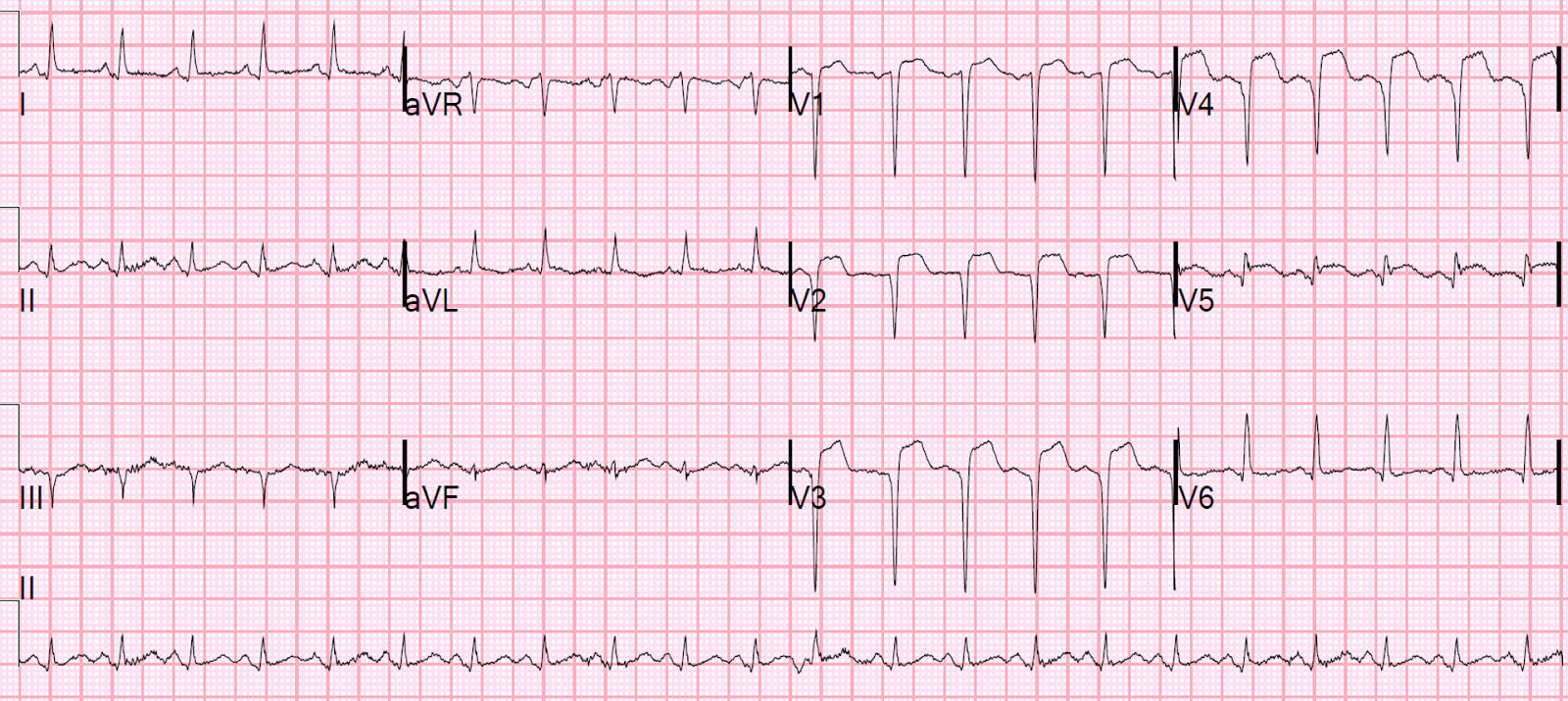 Dr. Smith's ECG Blog: ST Elevation and QS-waves in a patient with Dyspnea