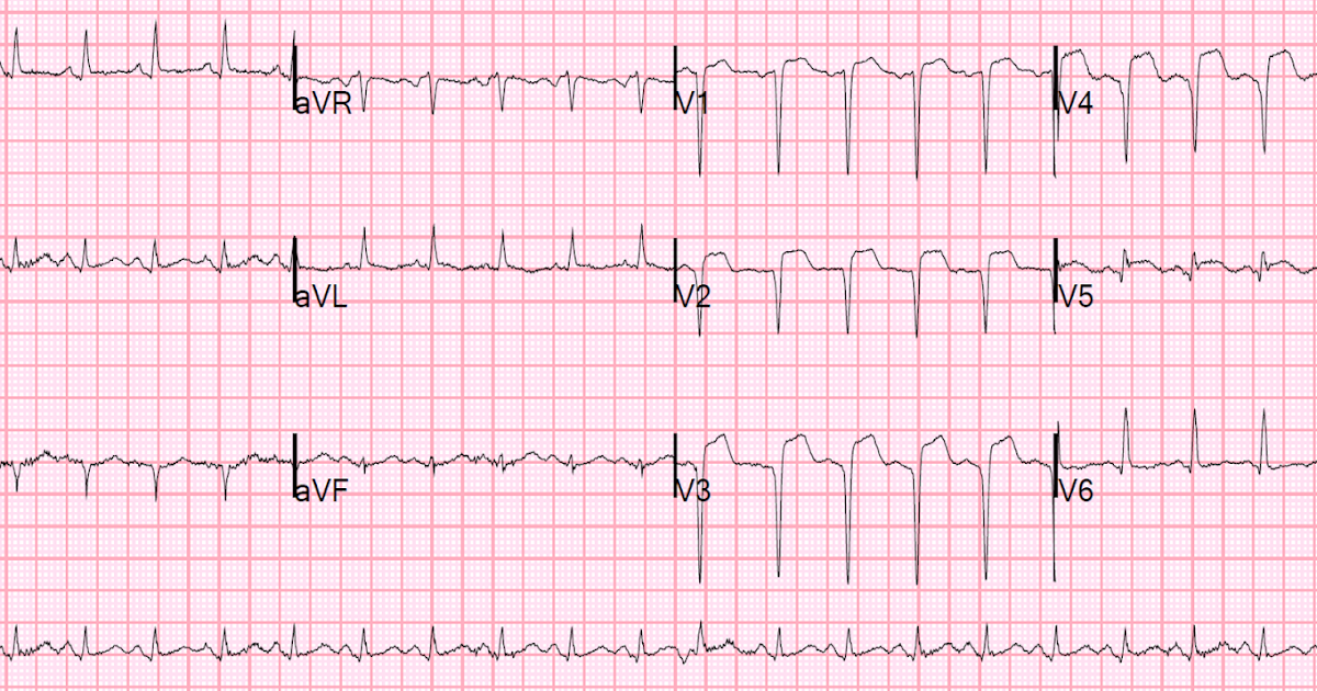 Dr. Smith's ECG Blog: ST Elevation and QS-waves in a patient with Dyspnea