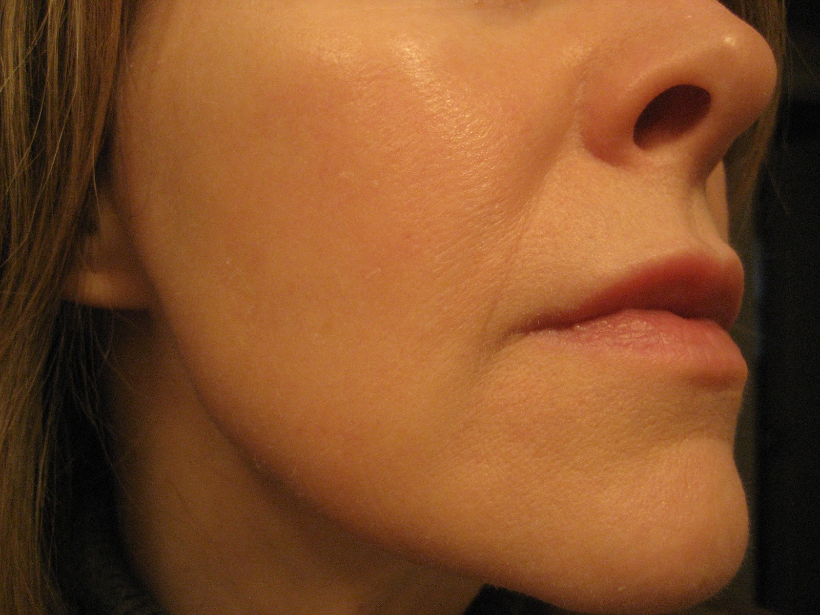 Chemical Peels for Acne and Anti Aging: Chemical Peel Progress