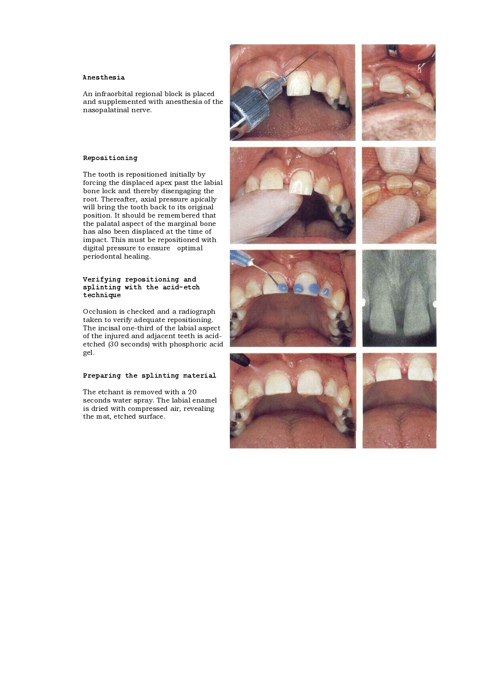DOs and DONTs in DENTISTRY: CONCUSSION ,SUBLUXATION,EXTRUSION ,LATERAL ...