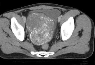 Cryptorchid Testis & Germ Cell Tumour-CT - Sumer's Radiology Blog