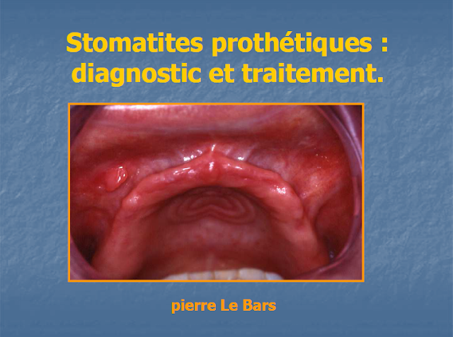 dentalivre: Stomatites prothétiques : diagnostic et traitement.