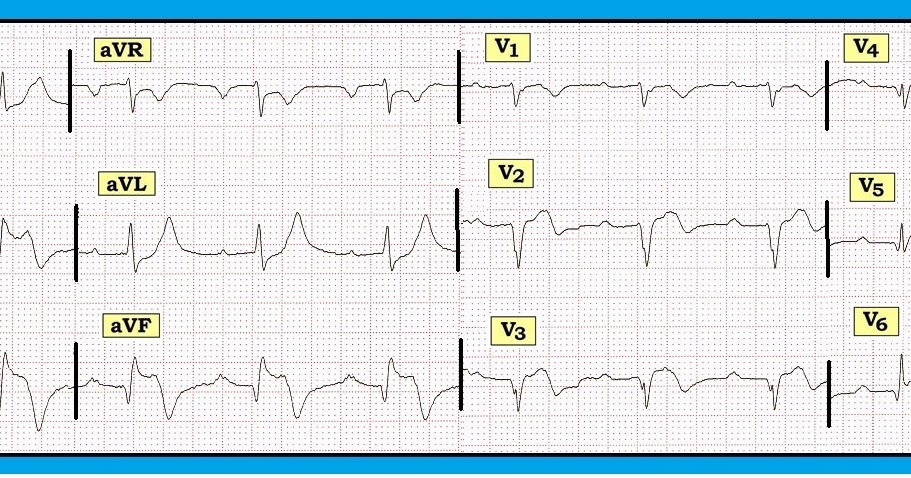 ECG Interpretation: ECG Interpretation Review #48 (Chest Pain - STEMI ...