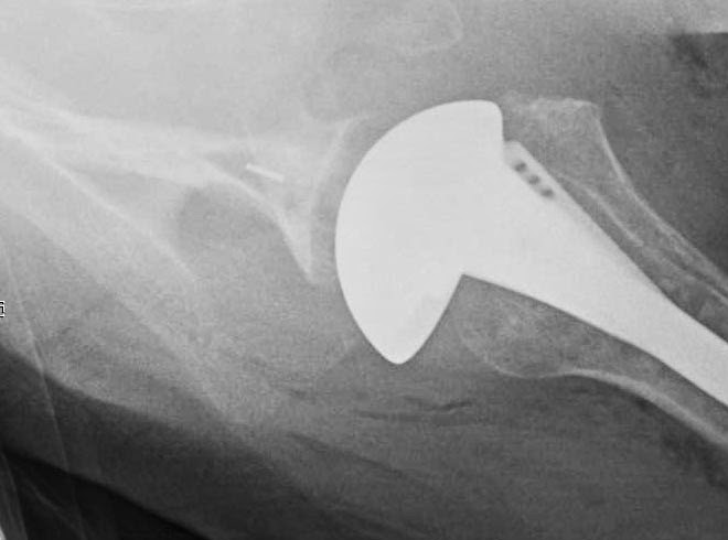 UW Shoulder and Elbow Academy: The magical role of eccentric prosthetic ...