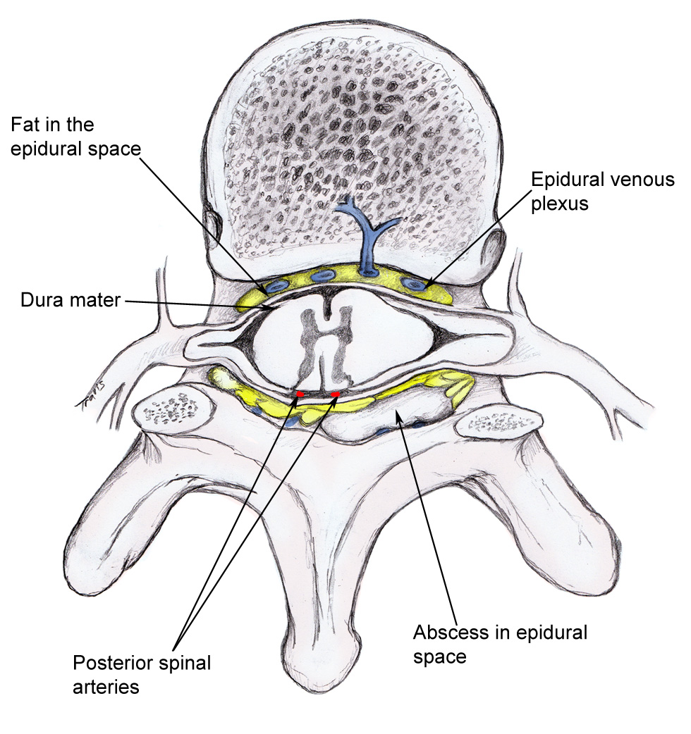 ABOUT NEUROSURGERY: Spinal Cord Abscess