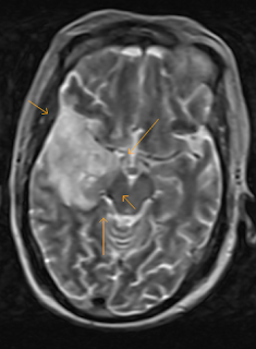 Temporal Lobe Cerebritis with Midbrain Compression - Sumer's Radiology Blog