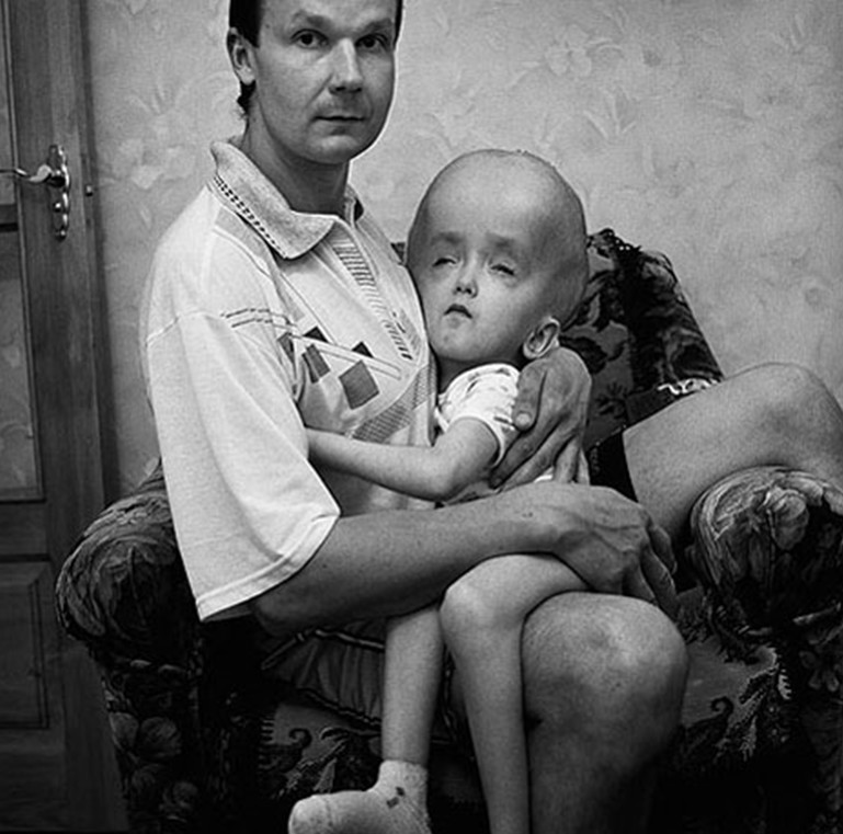 List 95+ Pictures Chernobyl Radiation Victims Photos Sharp 09/2023