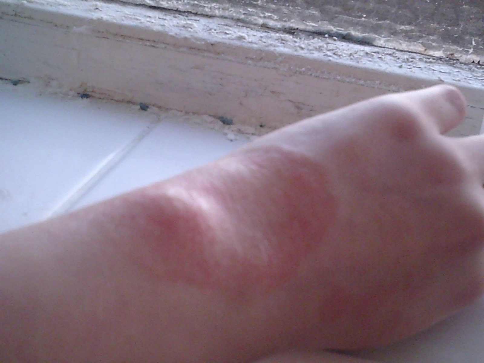 Diary of Lyme Girl: Congenital Lyme Re-occurring Bulls Eye Rash