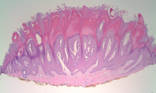 Dermatopathology: Verruca vulgaris