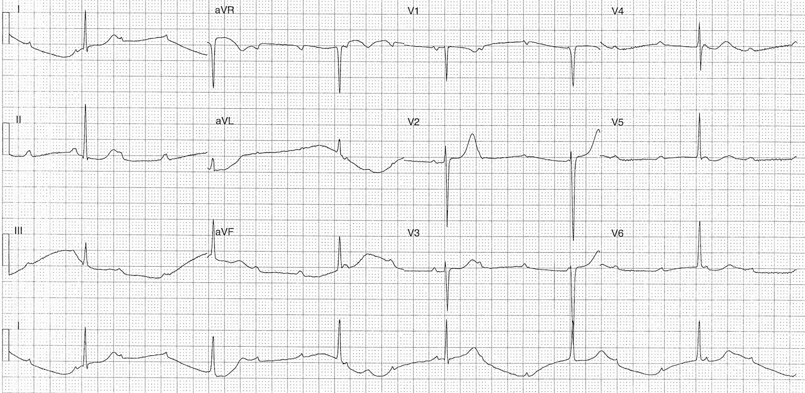 ECG of the Week: ECG of the Week - 12th November 2018 - Interpretation