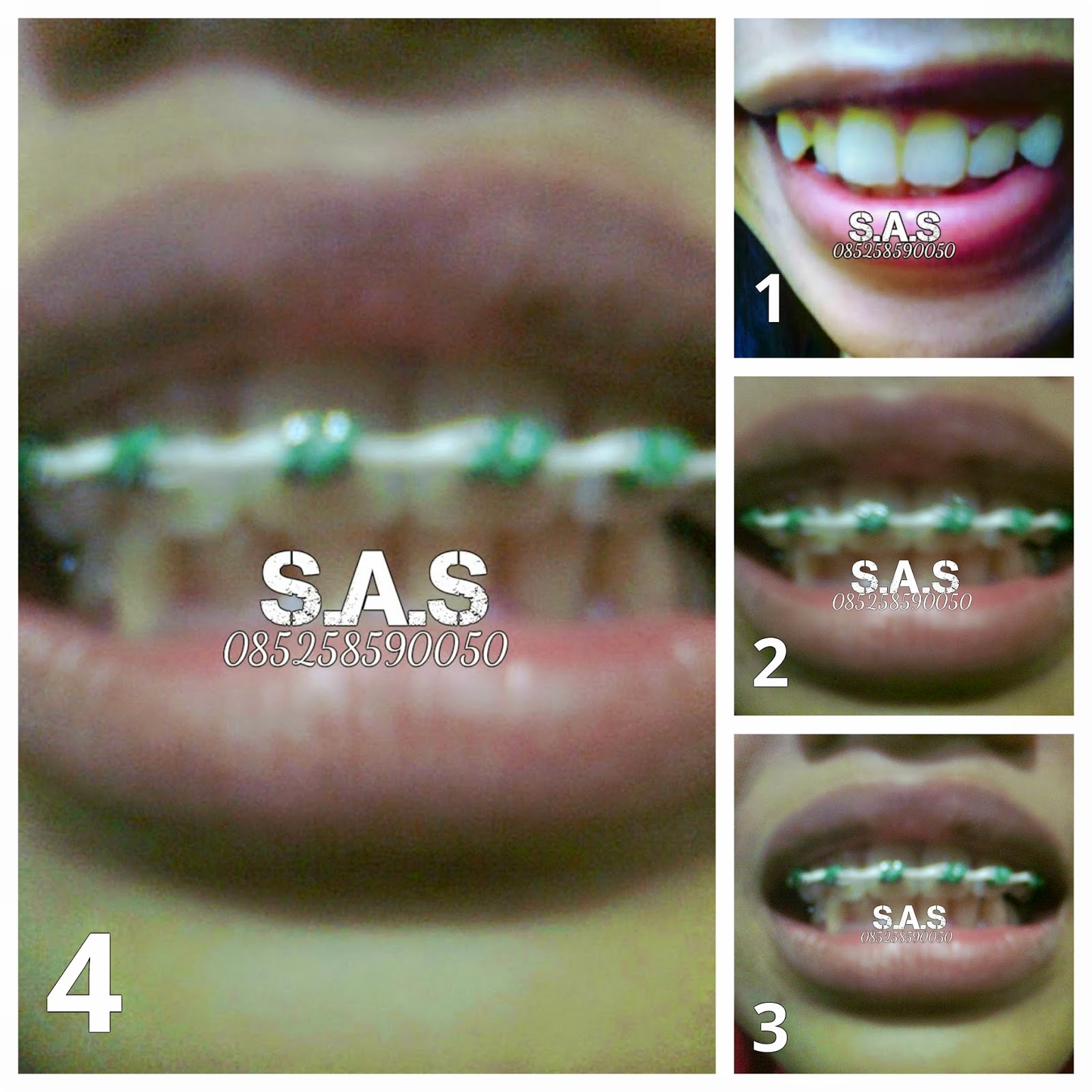 Foto Gigi Hasil Behel (Behel untuk Gigi Gingsul) Versi S.A.S Part 2 | S ...
