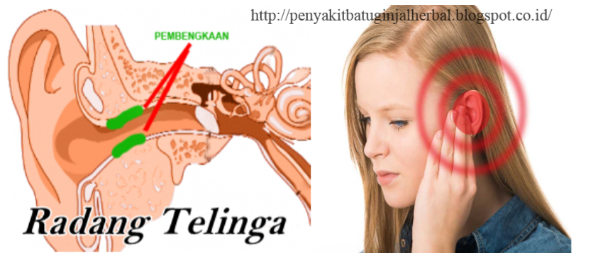 Cara Mengobati Penyakit Radang Telinga | AHLINYA PENGOBATAN GINJAL