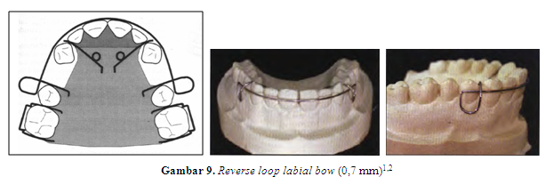 My little notes about dentistry: Beberapa Desain Kawat pada Pesawat ...