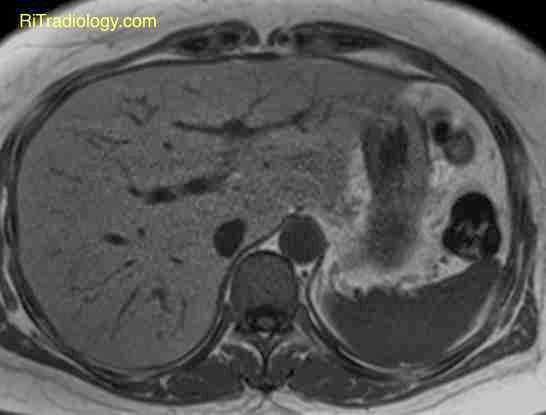 RiT radiology: Fatty Liver