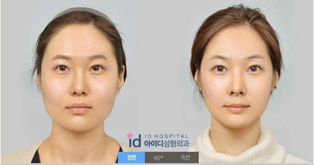 ID Hospital Korea: V line surgery before and after photos
