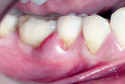 Absceso Periodontal
