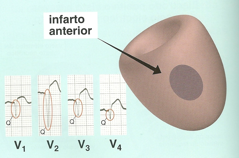 Electrocardiograma y Medicina General: Infarto agudo de miocardio de ...