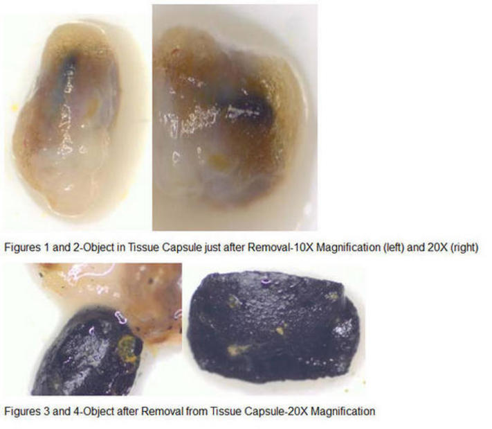 Taken By The Greys - Abductions: Alien Implants Removed and Small ...