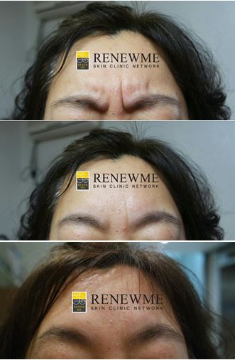 Renewme Skin Clinic Indonesia: Mengenal Cara Kerja dan Kegunaan BOTOX ...
