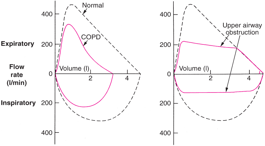 Medische Kennis: COPD