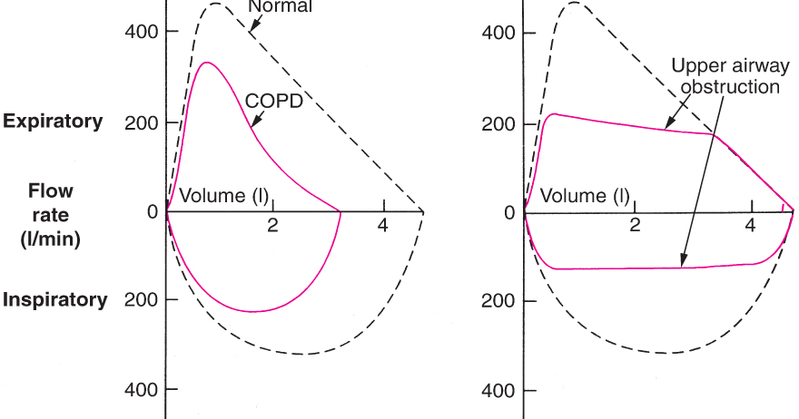 Medische Kennis: COPD