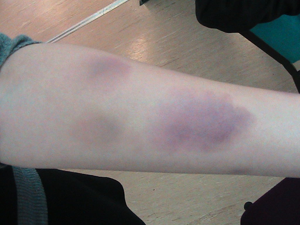 Penance: Fake Bruise Experimentation