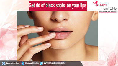 How to get rid of Black Spots on Your Lips | KEMPS Skin Clinic
