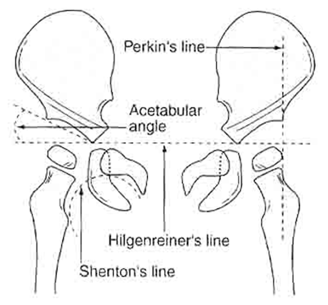 Shenton\'s line : KMLE 의학 검색 엔진 - 의학사전, 의학용어, 의학약어, 의학논문, 약품/의약품 검색