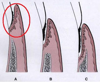 Dentistry lectures for MFDS/MJDF/NBDE/ORE: A NOTE ON CLASSIFICATION ...