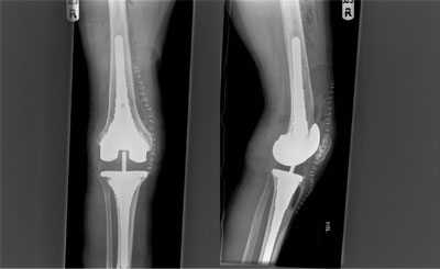$9 Billion a year in knee replacements | Buttafuoco & Associates
