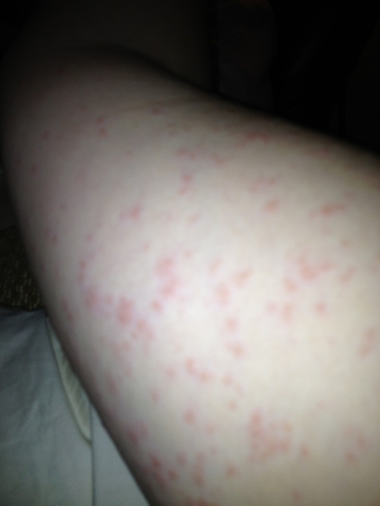 A Family Called the Bruners: What the PUPPP???