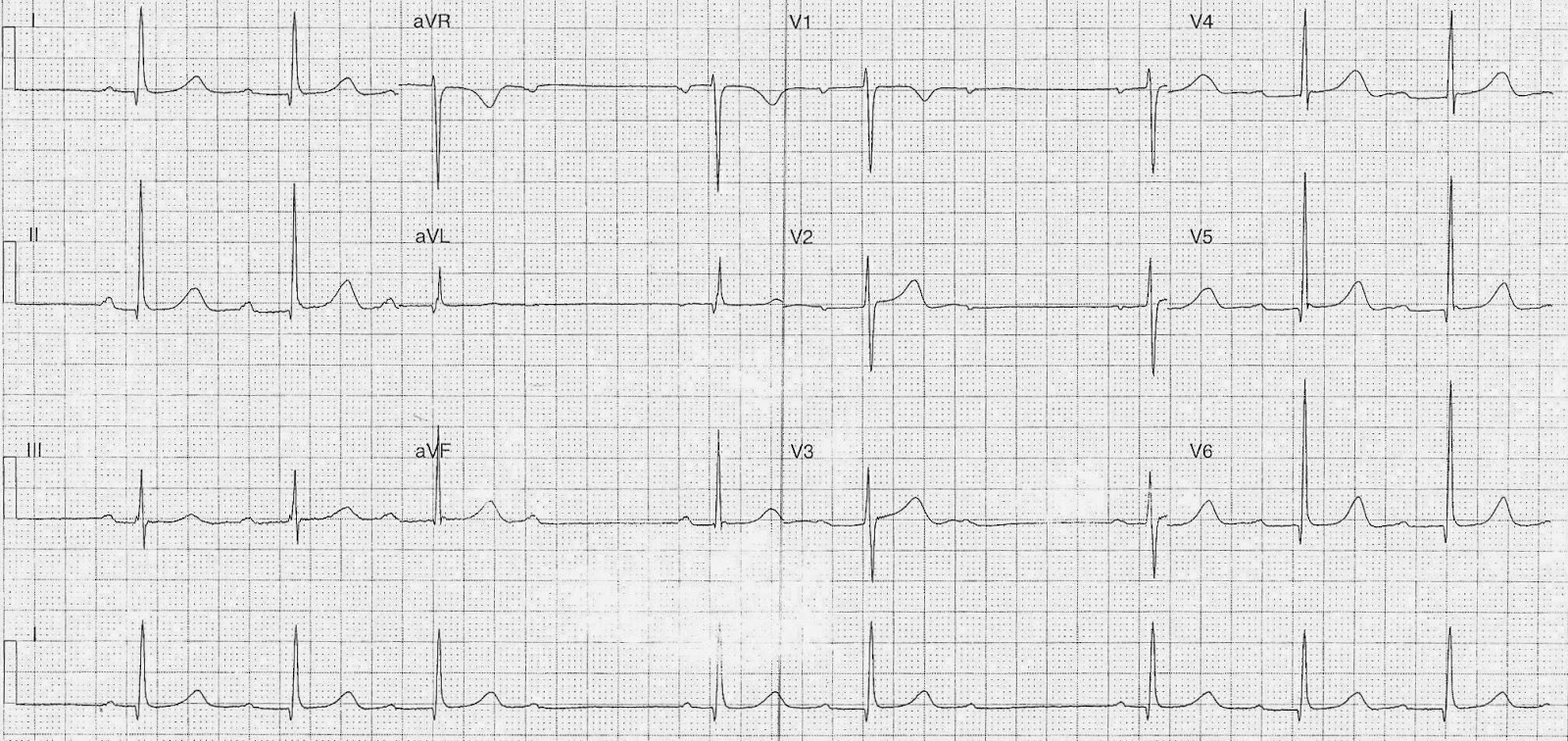 ECG of the Week: ECG of the Week - 1st April 2013