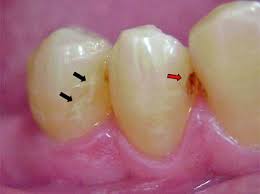 Clínica Dental Hernández Vela: Caries radicular, ¿qué es?