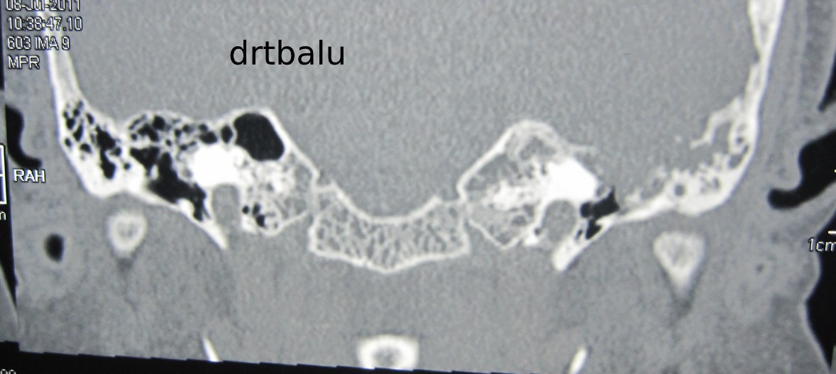 drtbalu's otolaryngology resources: An interesting case record of a ...