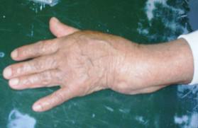 Locura medica: Fractura de Pouteau-Colles