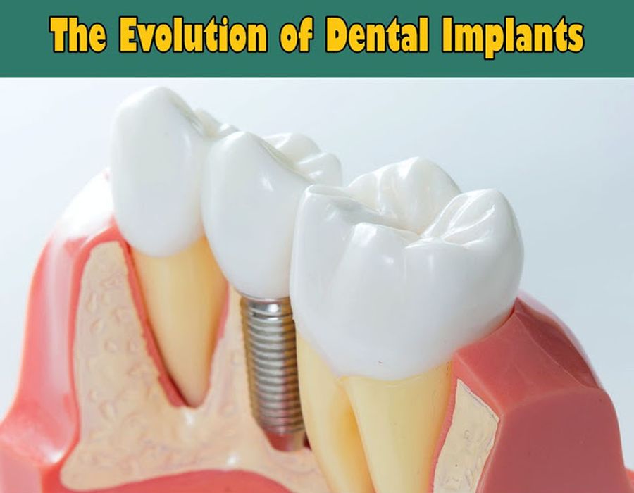 IMPLANTOLOGY: The Evolution of Dental Implants