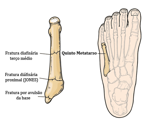 Clínica e Cirurgia do Pé e Tornozelo: Fraturas dos Metatarsos