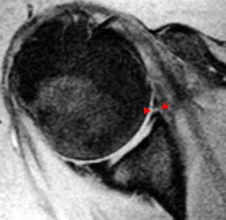 MRI Musculo-Skeletal Section: Labrum