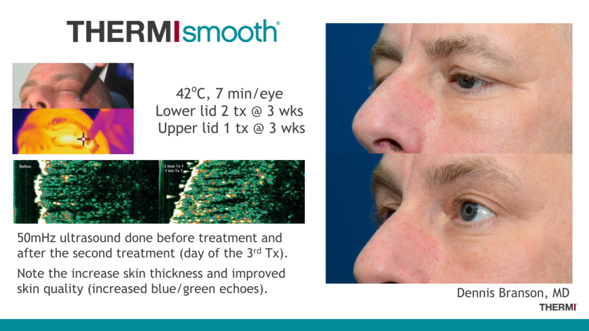 ThermiRF - Non Surgical Skin Face Treatment in Delhi, India