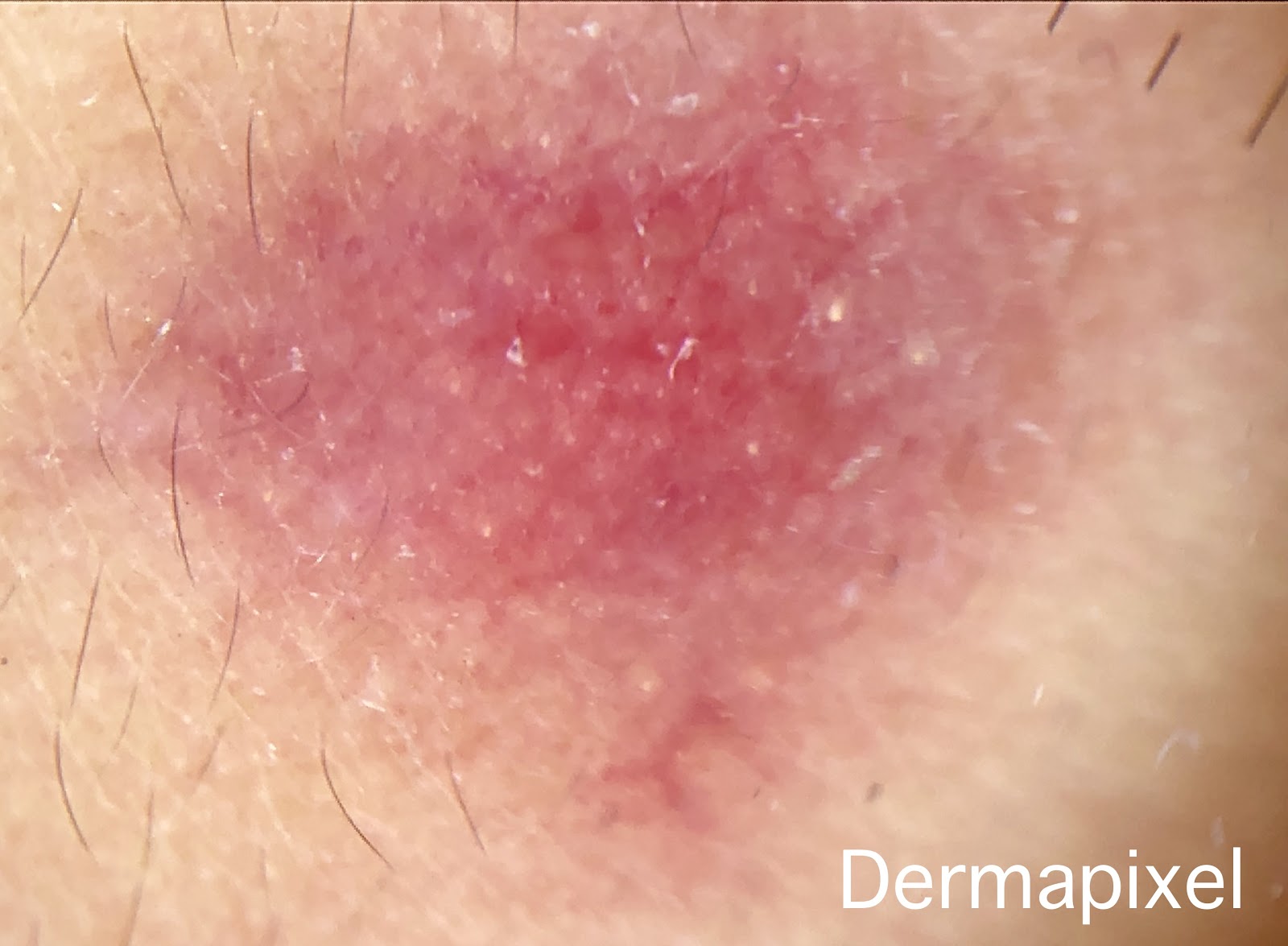 Dermapixel: septiembre 2018