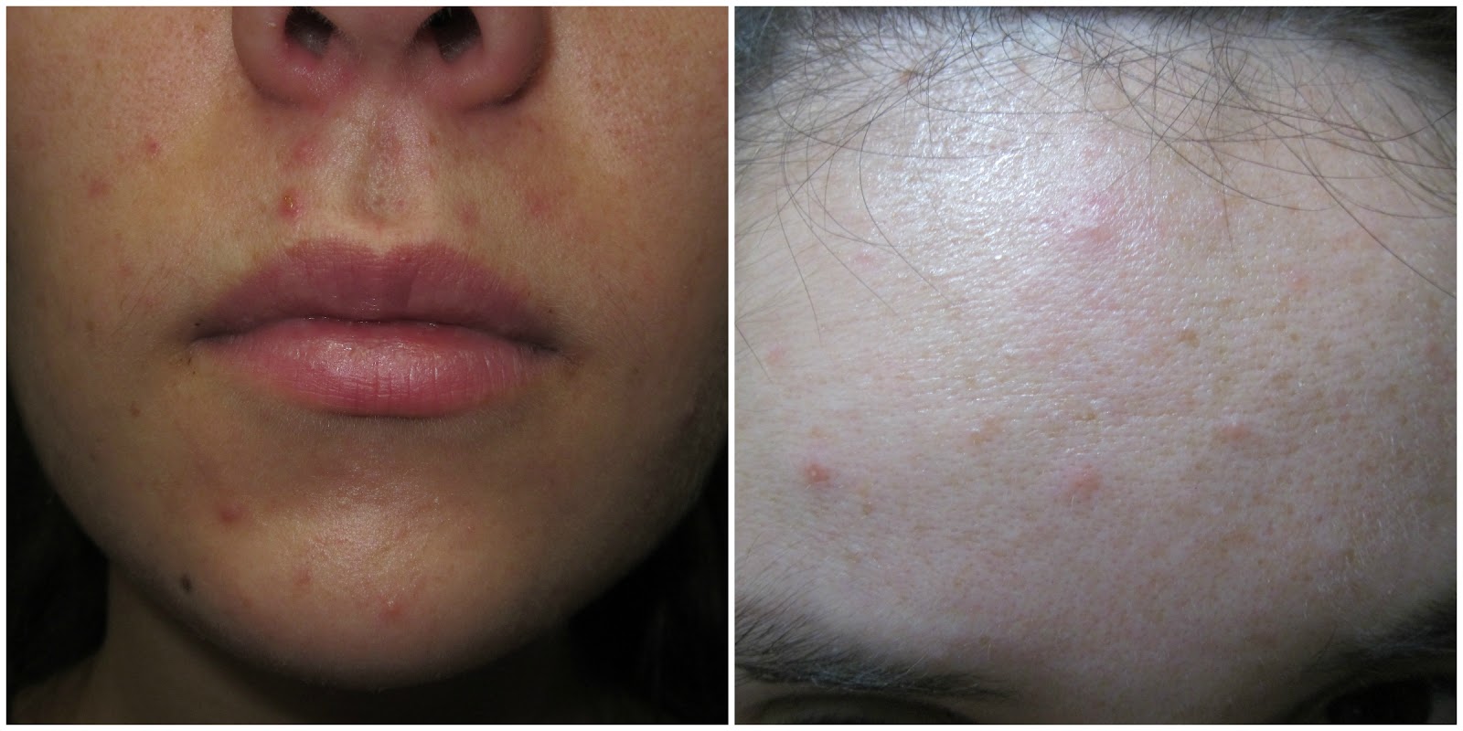 Blog de Asdfasdfasdfffffffff: Tratamiento para el Acné: 2 semanas de avance