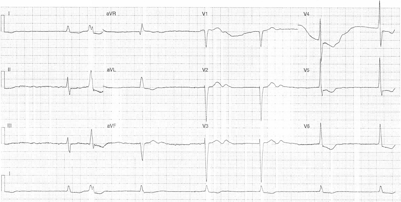 Ecg