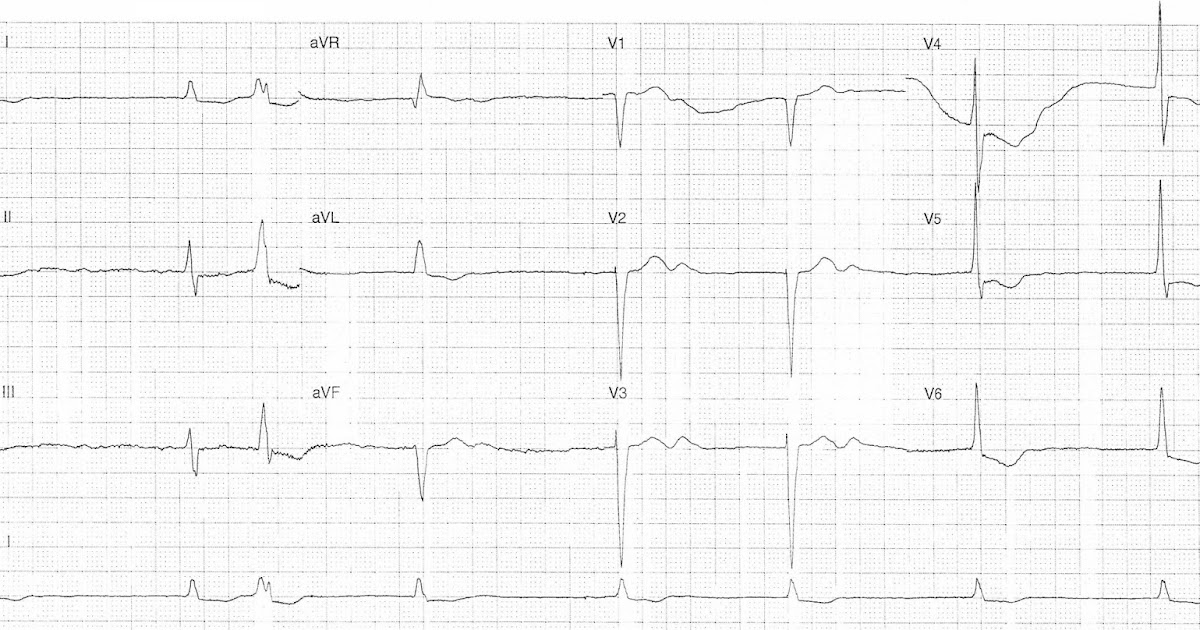 ECG of the Week: ECG of the Week - 9th May 2016 - Interpretation