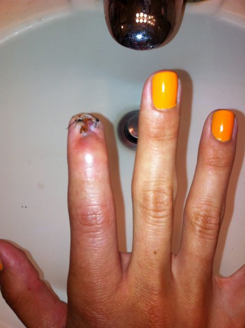 From Amy With Love: Cancer Finger