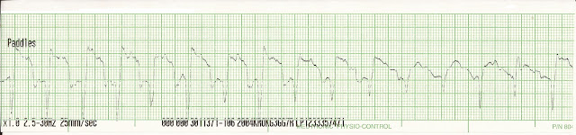Float Nurse: Pulseless VF/VT