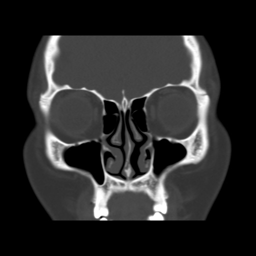 CT Paranasal Sinus Mild Deviation - Radiology Imaging