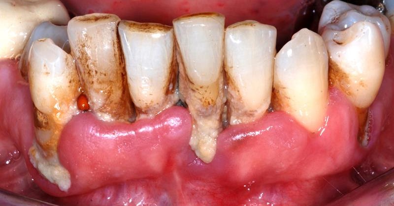 ¿Qué es la Periodontitis?