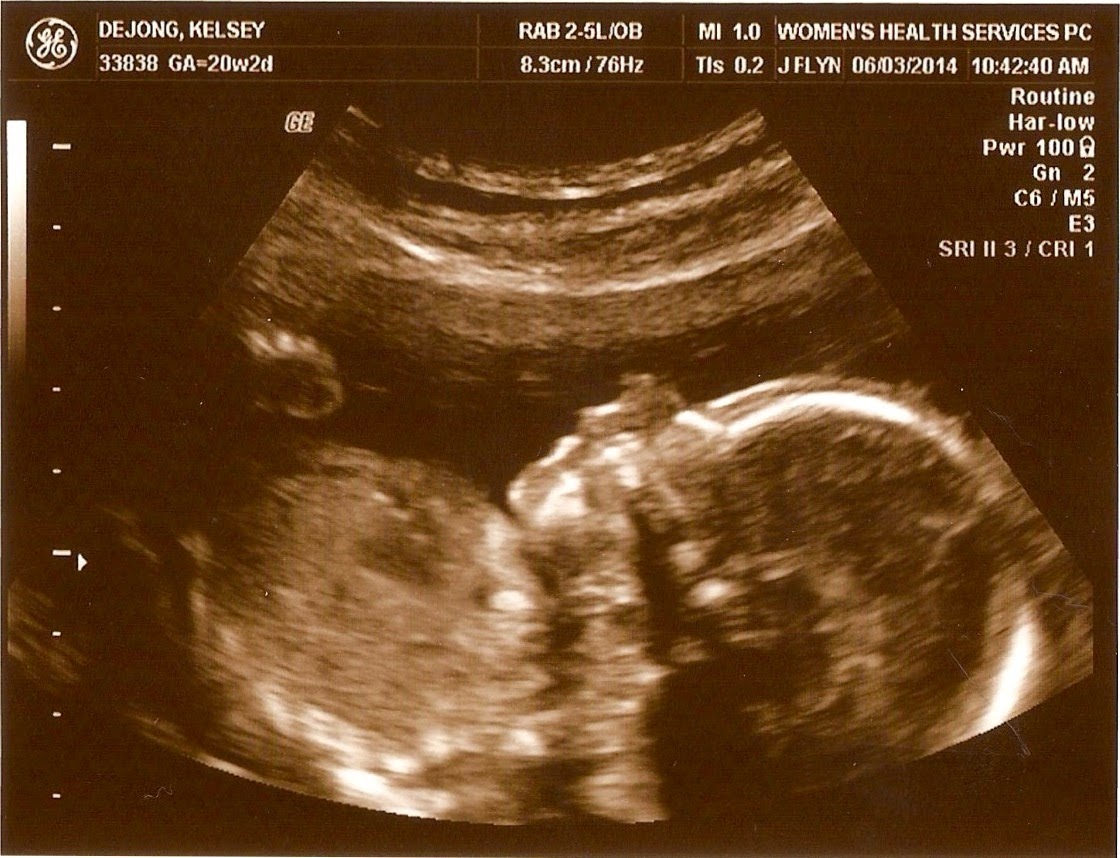 20 week ultrasound. ~ A Day with the De Jongs