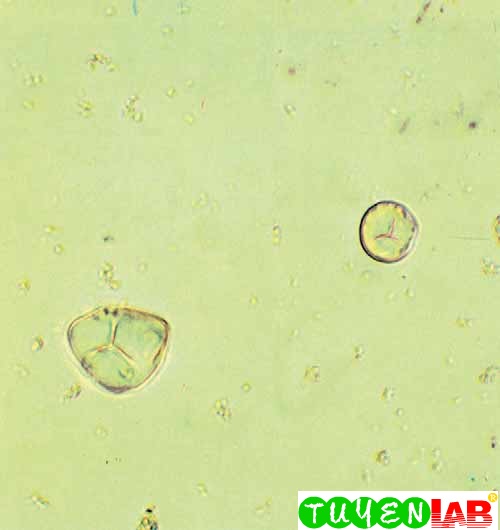 Atlas of Miscellaneous images in urine | Free Medical Atlas